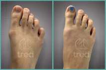 Minimally Invasive Bunion Surgery NYC — Tred Foot and Ankle Care